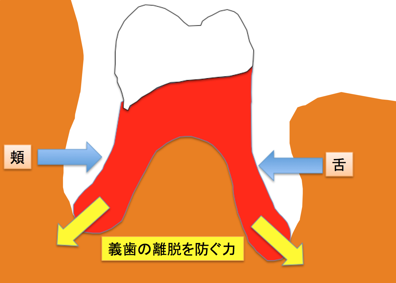 入れ歯について知ろう−その25−入れ歯の歯肉の形で入れ歯の安定さが変わる!|吹田市寿町の歯医者|よしなか歯科クリニック
